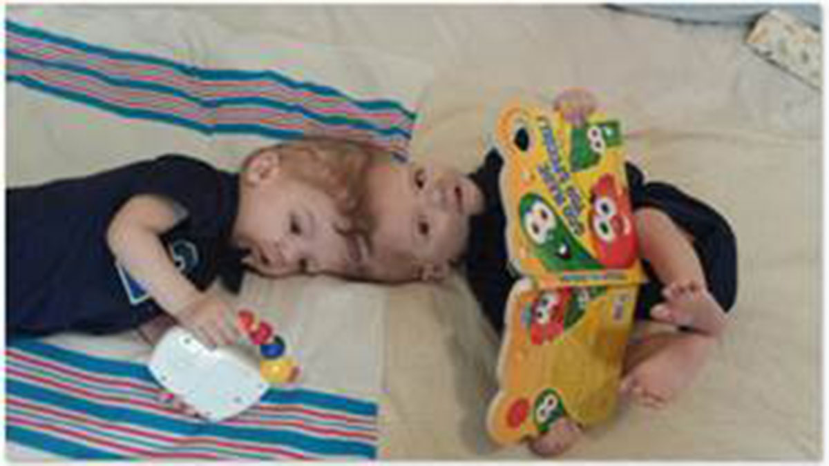 Conjoined Twin Boys Separated After 20-Hour Surgery at Bronx Hospital ...