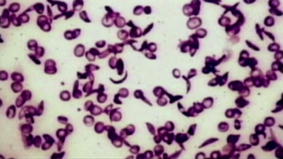 FDA approves groundbreaking treatments for sickle cell disease – NBC ...