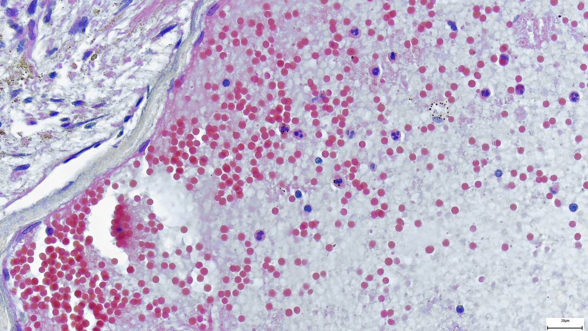 What is mpox and why has the WHO declared it a public health emergency ...