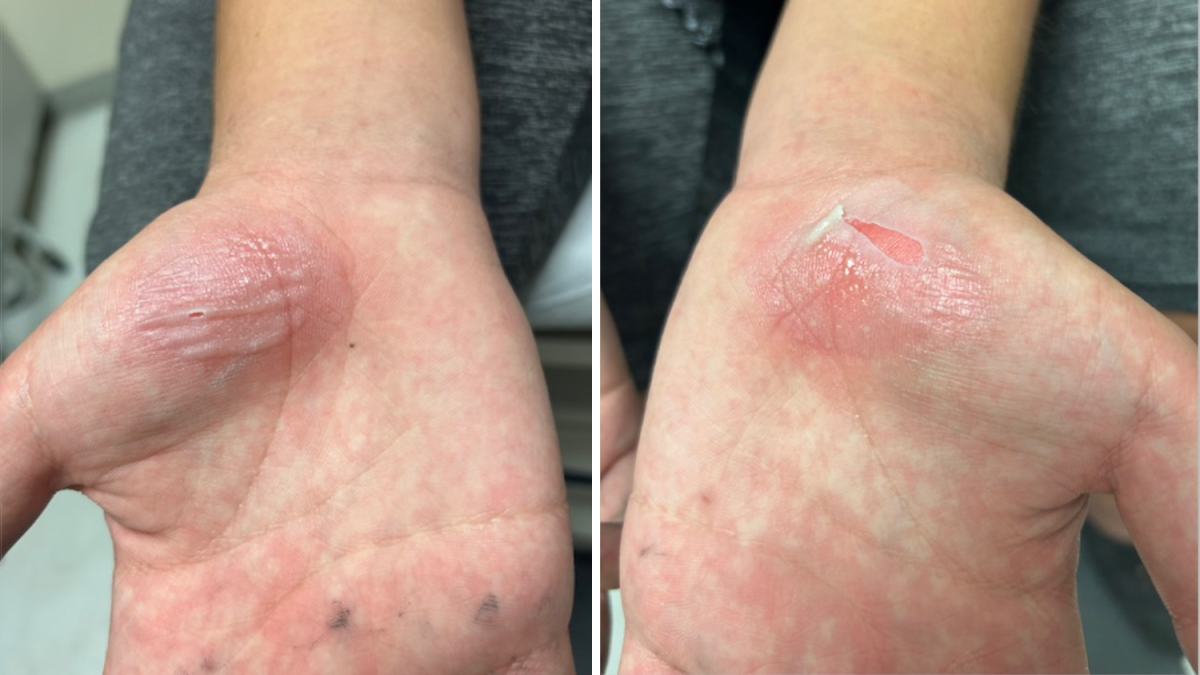 Las Vegas teen’s hands burned by hot turf during football – NBC New York