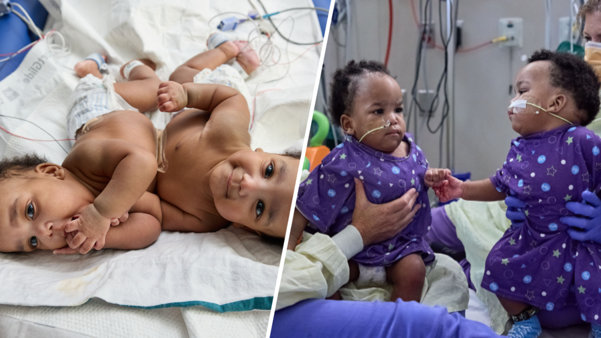 CHOP surgeons successfully separate conjoined twin boys – NBC New York