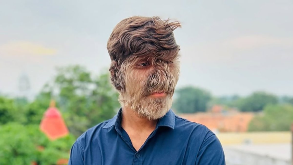 18-year-old sets Guinness World Record title for hairiest face – NBC ...