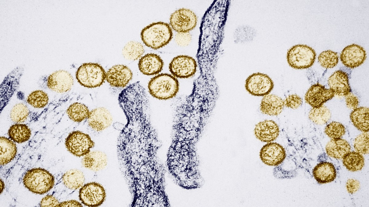 Gene Hackman’s cause of death: What is hantavirus pulmonary syndrome ...