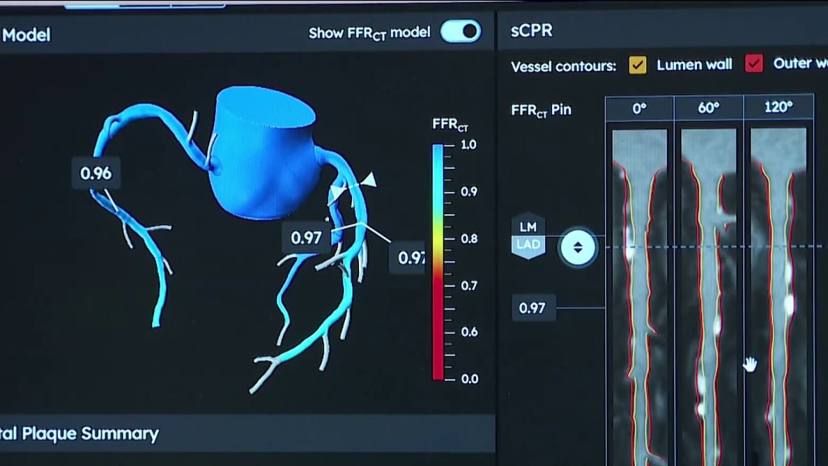 AI helps doctors diagnose heart disease at Long Island hospital – NBC ...