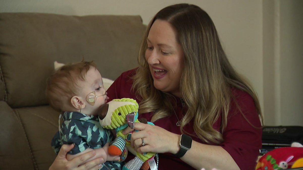 Major surgery nears for baby with facial defect – NBC New York