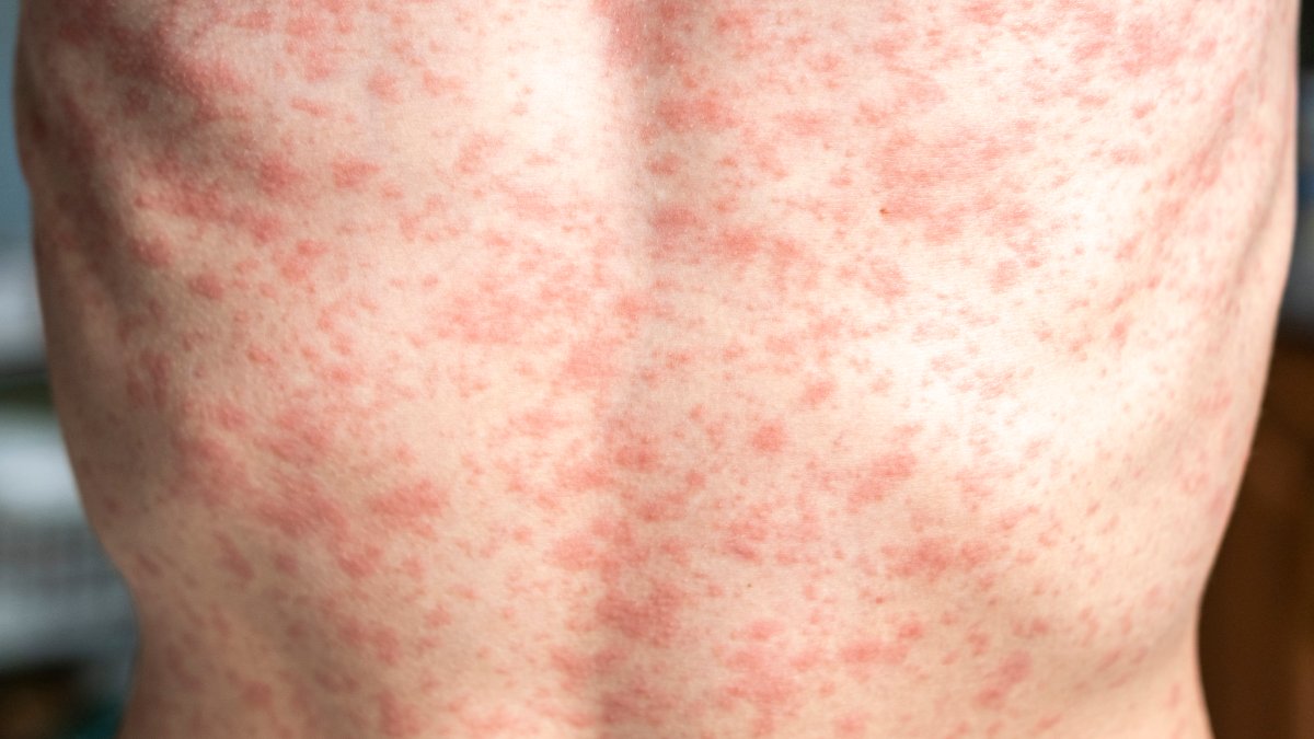 Measles cases confirmed in NYC and Long Island: What to know – NBC New York